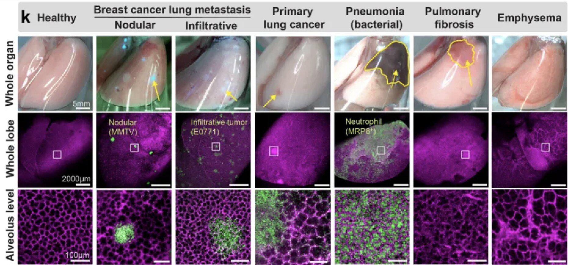 A Tecnologia De Caixa Torácica De Cristal é Pioneira Em Novas Abordagens Para A Saúde Pulmonar 